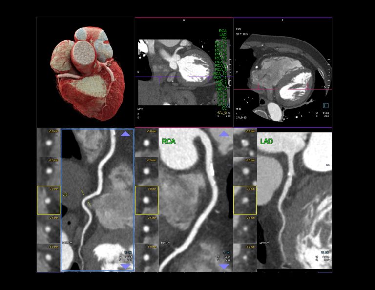 CT Angiography | Ascent CardiologyAscent Cardiology